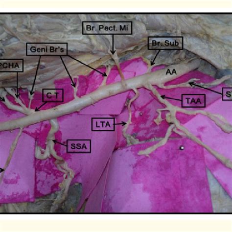 Anomalies In The Axillary Artery Without Pectoralis Minor Download