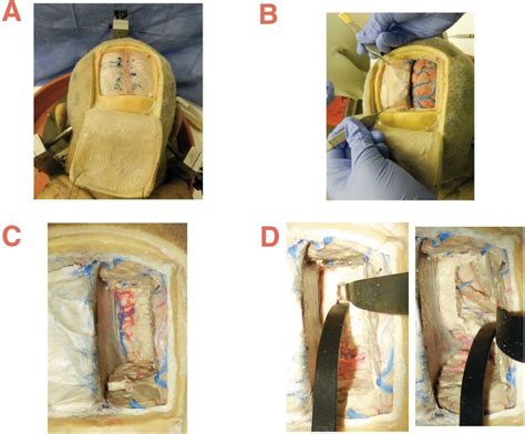 Cadaver Dissection Corresponding To The Illustration In Figure 4 Shows