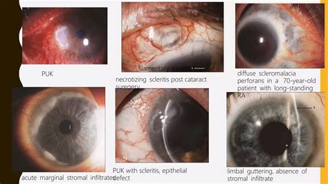 Peripheral Corneal Diseases Pptx