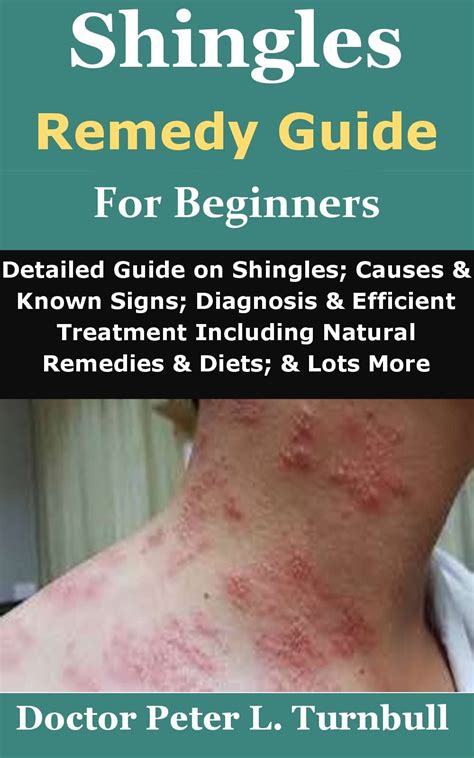 Shingles Remedy Guide For Beginners Detailed Guide On Shingles Causes