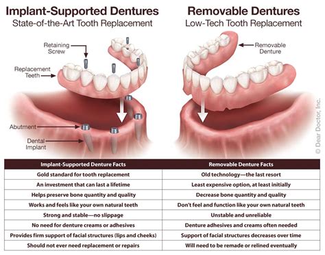 Fixed Dentures Dentistry Orthodontics