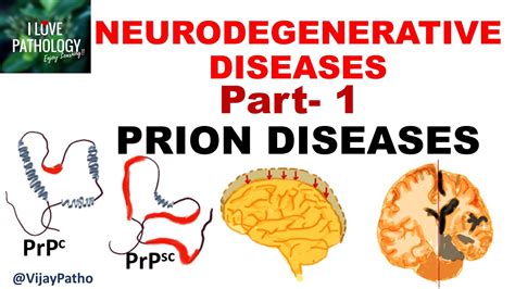 Neurodegenerative Disease Management Nnkhc