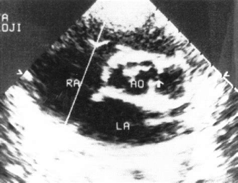 Figure 1 From Allograft Aortic Root Replacement For Aortic Valve Endocarditis With