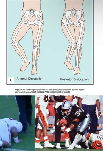 Hipthigh Anatomy And Injuries Flashcards Quizlet