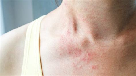 Atopic Vs Contact Dermatitis Whats The Difference Page 12
