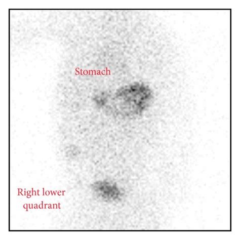 Technetium 99 Scan Demonstrating Gastric Mucosa In The Stomach And In