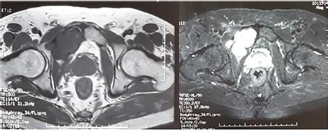 Figure 2 From Enneking Type Iii Resection Of Pubic Chondrosarcoma A