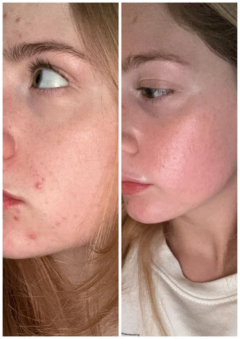 One Month On Accutane R Accutane