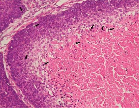 Histopathologic Findings Biopsy Shows Hyperchromatic Basaloid Cells