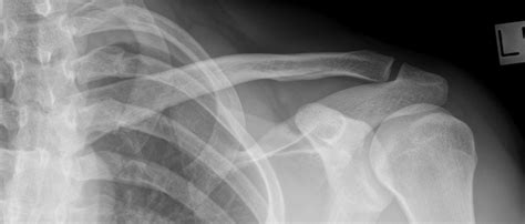 Normal Clavicle Xray