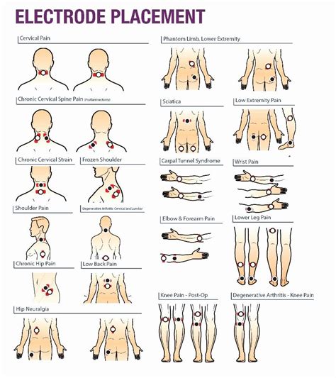 Electrode Placement For Tens Unit Chart