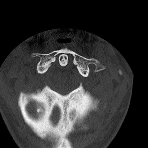 Occipital Condyle Fracture Radiopaedia 31755 32691 Axial Bone Window