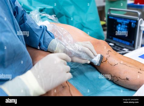 Process Of Varicose Vein Surgery In Hospital Operating Room Vein