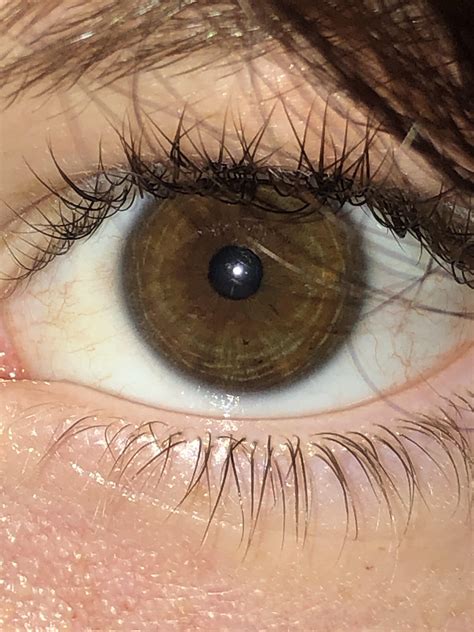 Central Heterochromia Brown Eyes