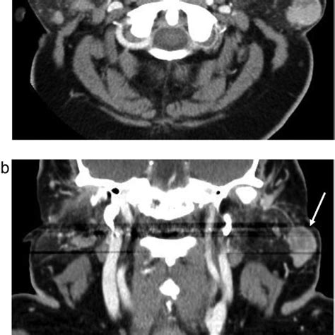A Axial Contrast Enhanced Ct Of The Parotid Gland Demonstrates A