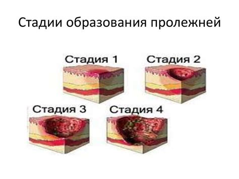 Профилактика пролежней - презентация онлайн