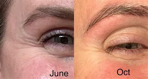 Share Your Mistake When Using Tretinoin For The First Time Rtretinoin