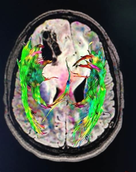 Diffusion Tensor Imaging Dti Tractography From An Mri Scan Of The Brain … Umar Mushtaq