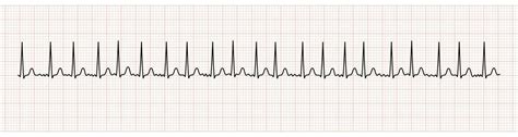 Atrial Fibrillation Vector Art Icons And Graphics For Free Download