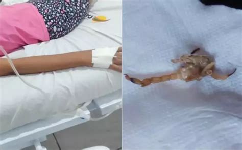 Estado de menina picada por escorpião é crítico e próximas horas serão