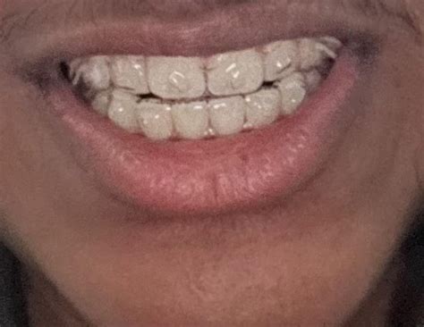 26 Weeks Progress Rinvisalign