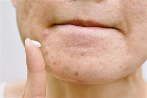 Những Nguyên Nhân Khiến Mụn Quai Hàm Mọc đi Mọc Lại Vietskin