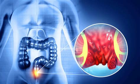 Hemorrhoid Diagnostic Testing New England Endovascular Center