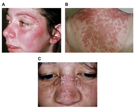Lupus Types Of Lupus Clinical Guidance