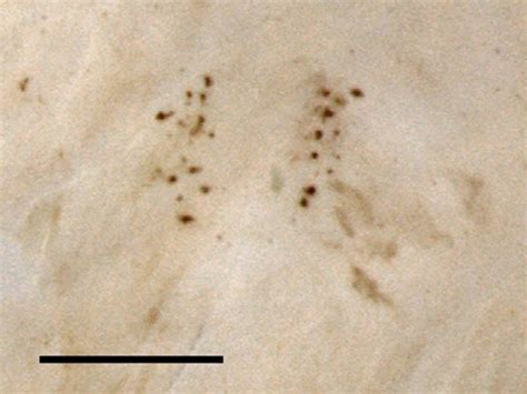 The V Shaped Scarring Pattern Caused By The Jaw Like Structures In The