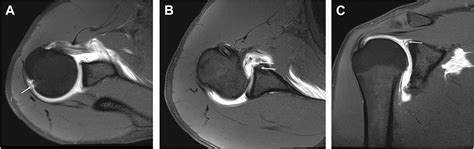 Value Of Direct Magnetic Resonance Arthrography Advances In Clinical