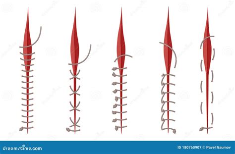 Different Surgical Stitches Isolated On White Background Vector Set