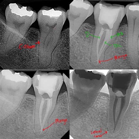 The Short Case Of The Day Tooth Apex Endodontics P C
