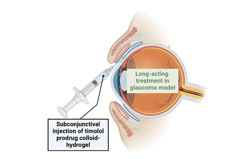 This New Drug Delivery Method Could Offer Long Lasting Relief For Eye