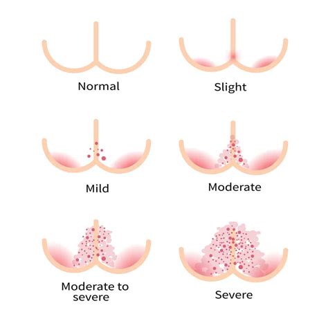 How To Treat And Prevent Diaper Rash Mothers And More