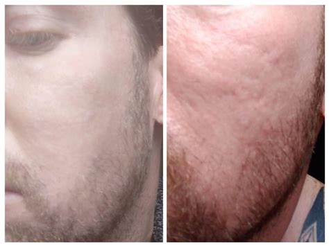 Further Acne Scar Update Racnescars