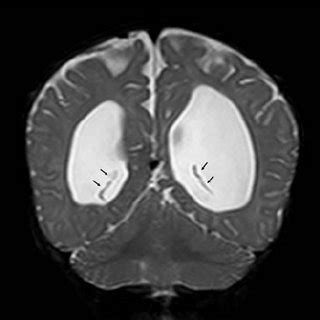 PDF The Choroid Plexus A Comprehensive Review Of Its History Anatomy Function Histology