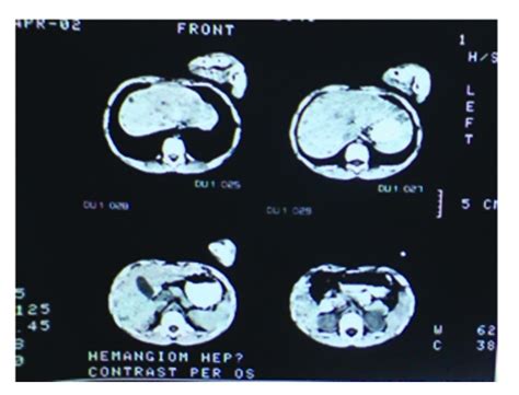 Computed Tomography Showing Multiple Liver Lowdensity Lesions