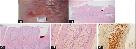 Verruciform Xanthoma In Recessive Dystrophic Epidermolysis B