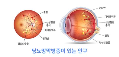 당뇨망막병증 ⋆ 부천미소안과