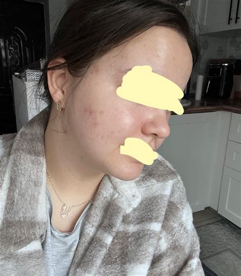 Does Tret Make Me Gain Post Acne Scars Rtretinoin