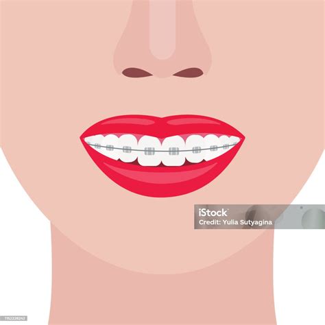 미적 중괄호와 아름 다운 여성 미소 치아 교정 벡터 일러스트 개선에 대한 스톡 벡터 아트 및 기타 이미지 개선 건강관리와