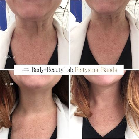 How To Get Rid Of Neck Bands Charlettemallegni