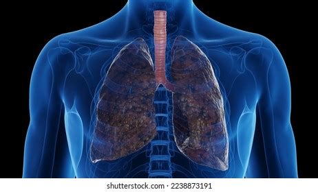 Smokers Emphysema Images Stock Photos Vectors Shutterstock