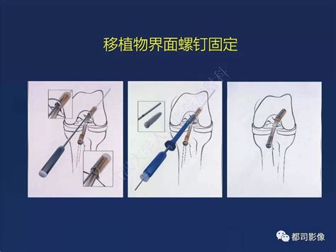 前交叉韧带损伤及重建术后的MR评价 好医术早读文章 好医术 赋能医生守护生命