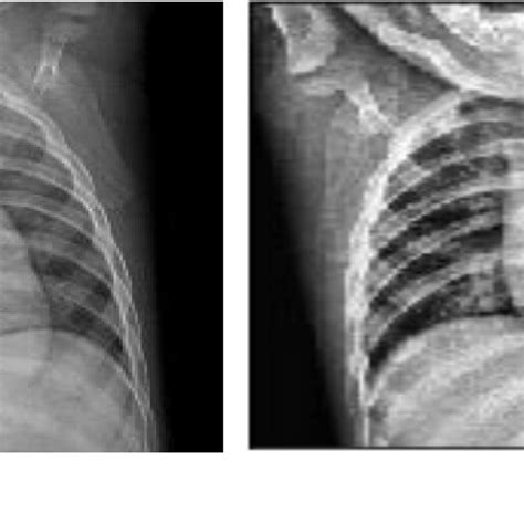 A Original Image And B Image With Contrast Limited Adaptive