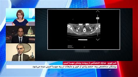 یک گروه هکری تصاویر سی‌تی‌اسکن از جمجمه مهسا امینی را منتشر کردند Youtube