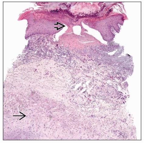 Chondrodermatitis Nodularis Helicis Basicmedical Key