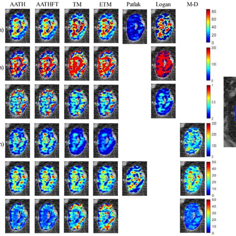 Parameter Estimates Of All Perfusion Parameters Inside The Tumor Region Download Scientific