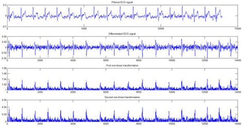 Qrs Detection Methodology The Results Different Steps In Deriving The