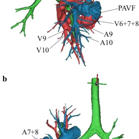 A B 3d Ct Reconstruction Demonstrated That The Lesion Was An Abnormal Download Scientific